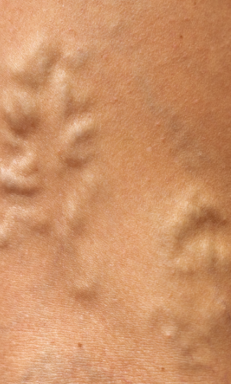 Vein Disease | Harvard Trained Vein Doctor in California