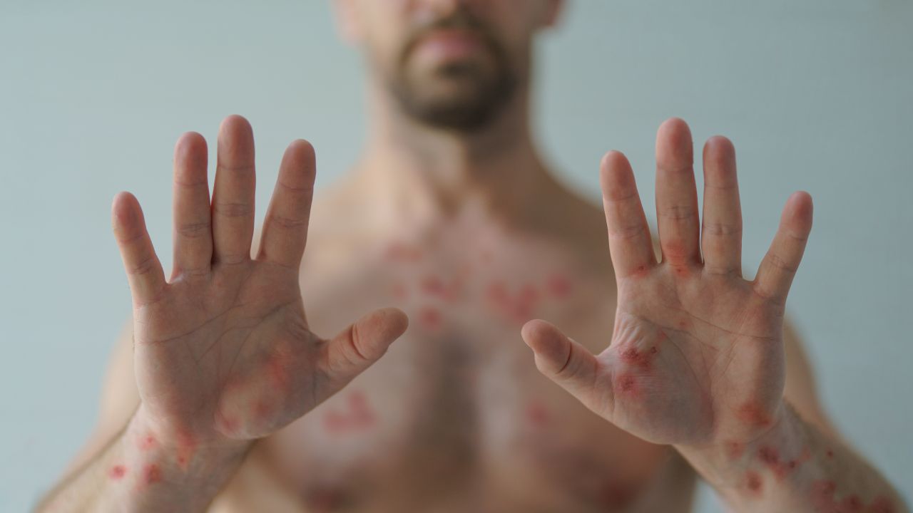 Can Monkeypox affect your veins? What you need to know!
